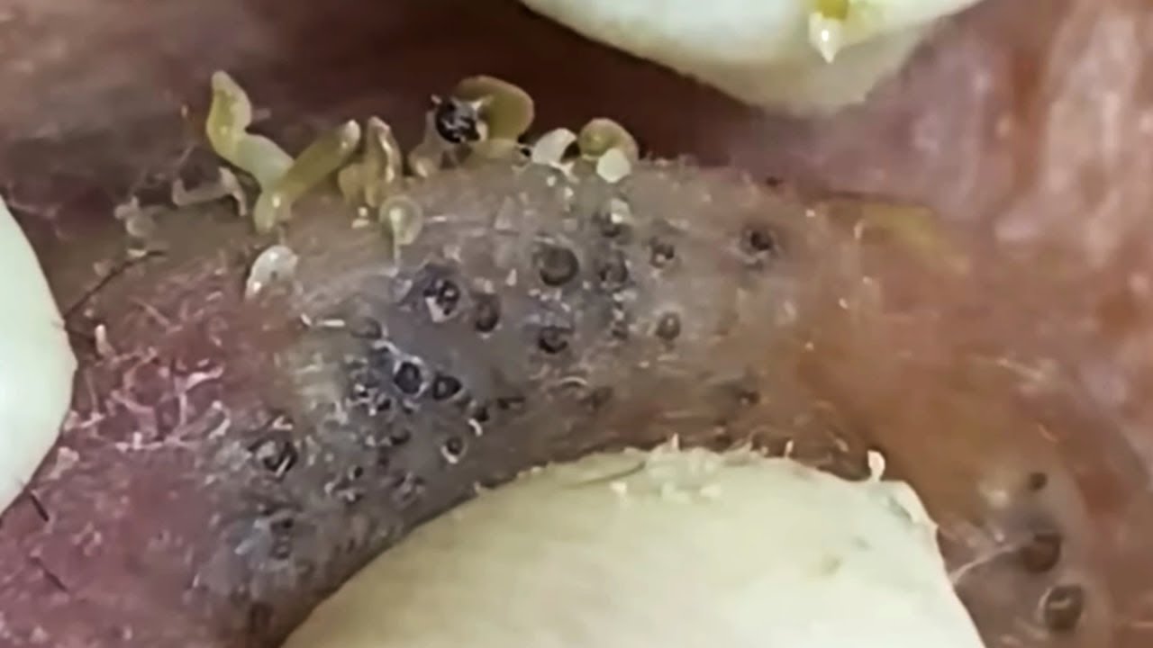 Satisfying Acne and Pimple Removal Blackheads & Whiteheads #1233 - YouTube