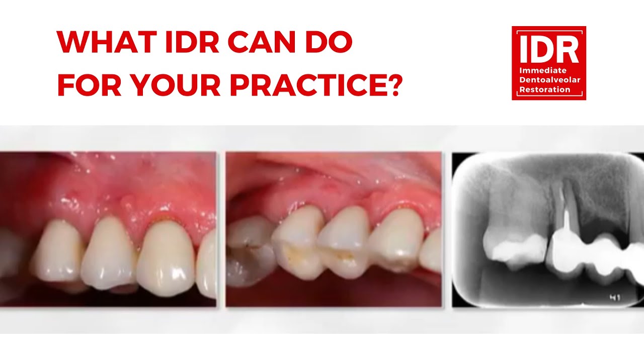 What IDR can do for your dental practice - webinar clip-Part1 - YouTube