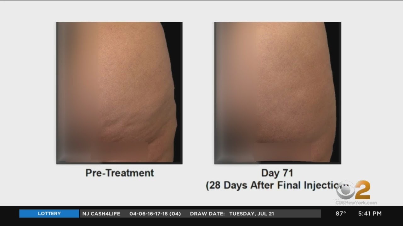 FDA Approves Injection That Dissolves Cellulite - YouTube