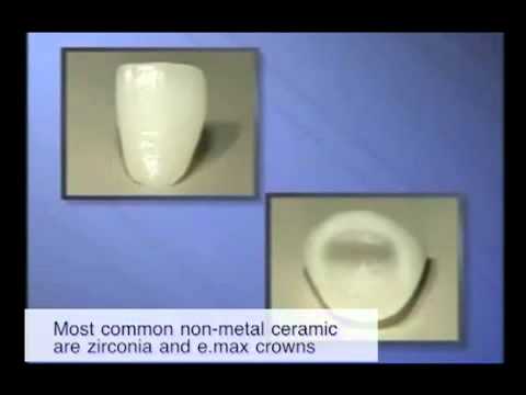 Standard crown PFM VS all Ceramic crowns - YouTube