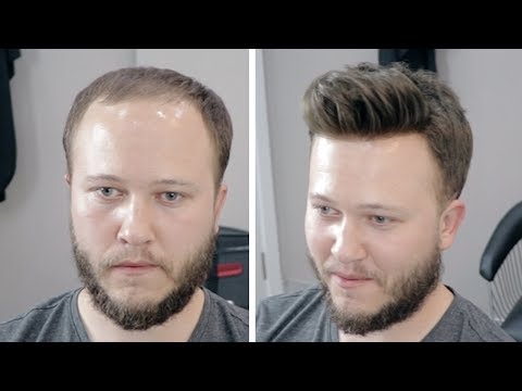 PROTEZ SAÇ UYGULAMASI - Hair Replacement
