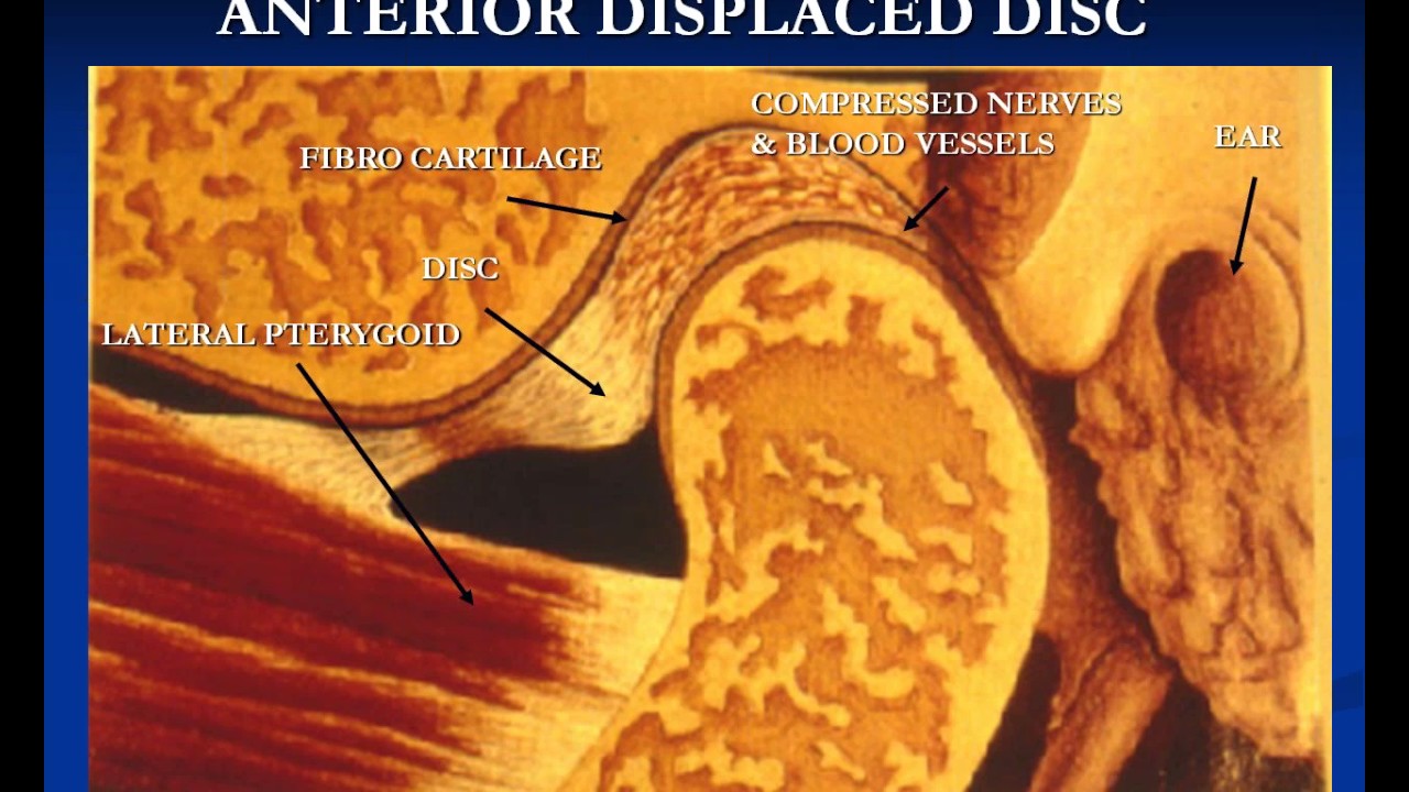 Introduction to Diagnosis and Treatment of TM Dysfunction - YouTube