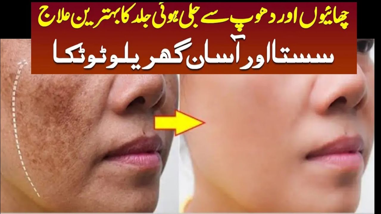How To Get Rid of Pigmentation | Best pigmentation Removal Cream ...