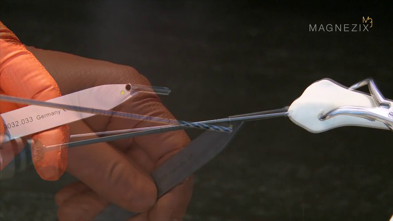 02 Treatment of a processus styloideus radii fracture with MAGNEZIX CS ...