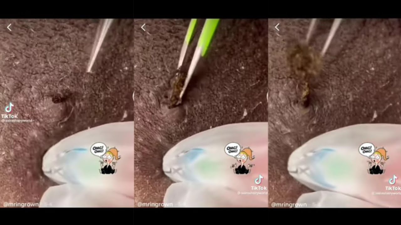Relax & watch this 😌(satisfying ingrown hair extraction/removal) - YouTube