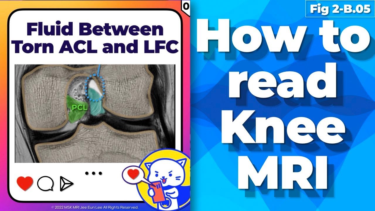 (Fig 2-B.05) Fluid between torn ACL and lateral femoral condyle ...