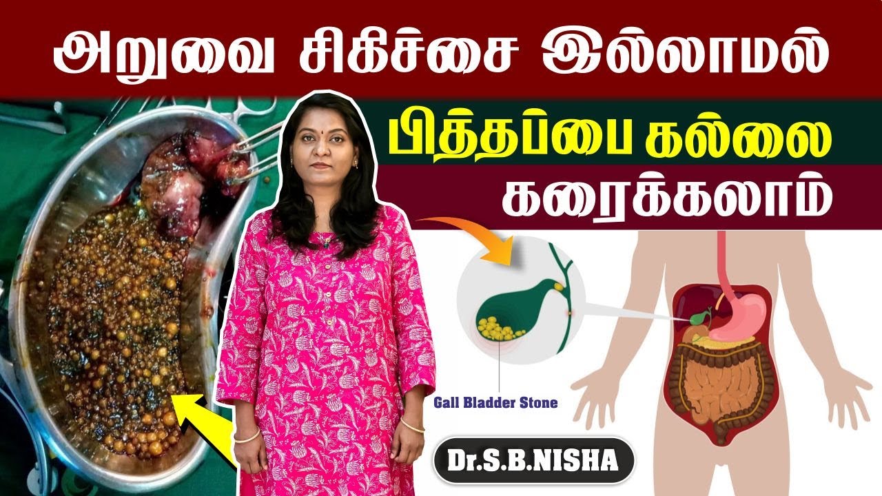 அறுவை சிகிச்சை இல்லாமல் பித்தப்பை கல்லை கரைக்கலாம் Gallbladder Stone # ...