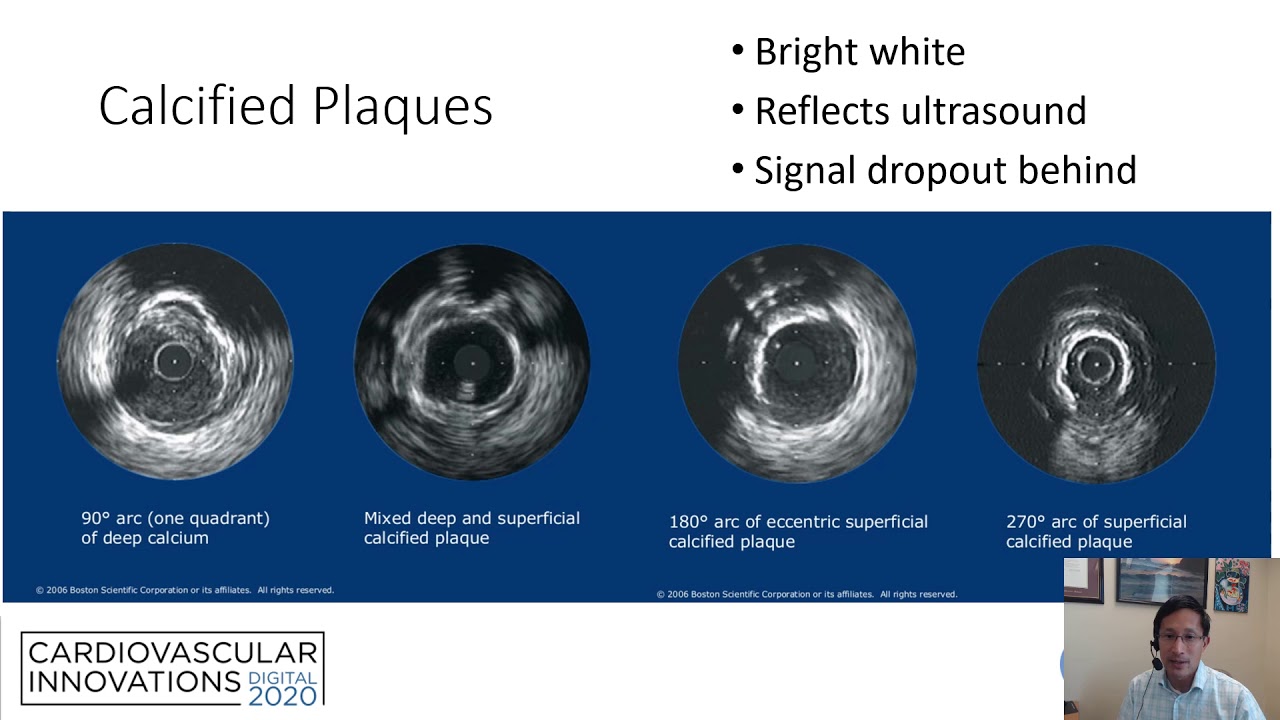 IVUS guided PCI: step-by-step_Seto_Coronary On Demand - YouTube