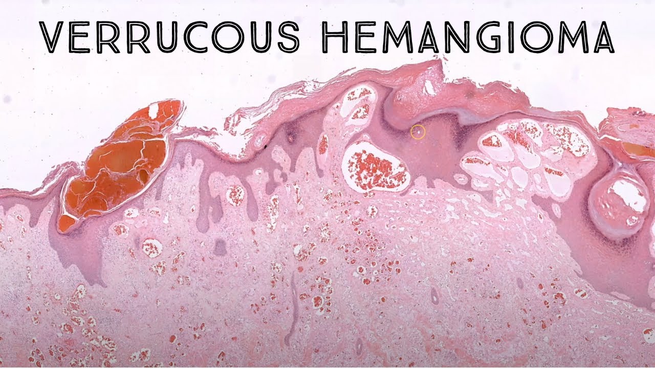 Verrucous Hemangioma (pathology dermpath dermatology dermatopathology ...
