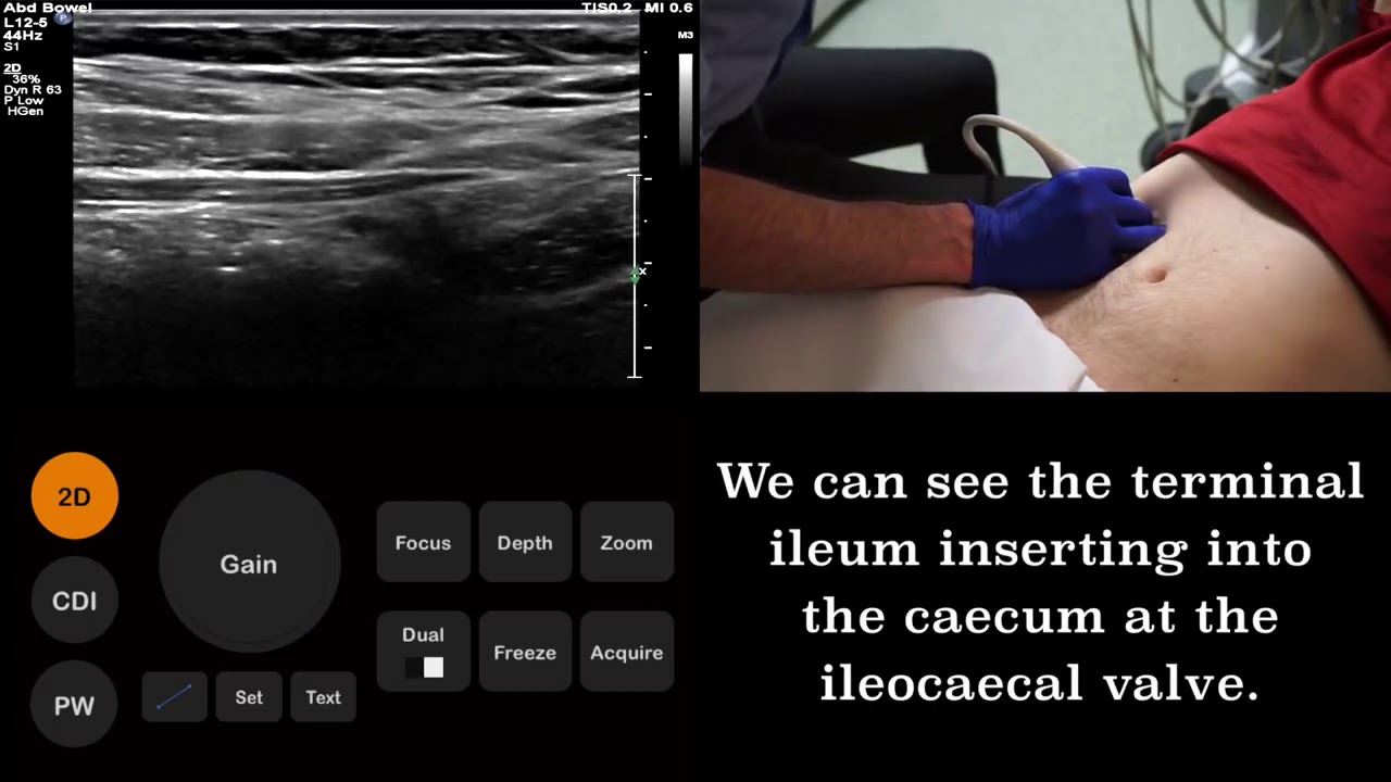 Ultrasound Tutorial Appendix Appendicitis-Radiology Nation - YouTube