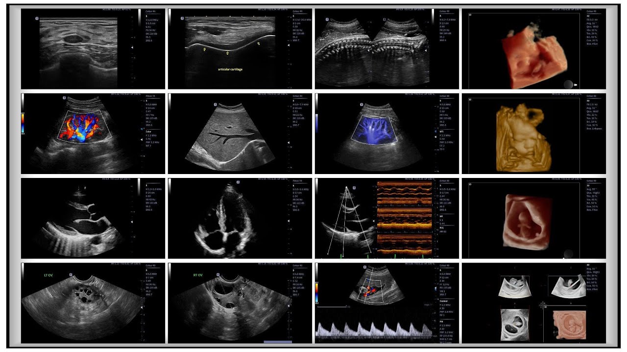 Enhancing Diagnostics: Advanced Ultrasound Imaging for GI Applications ...