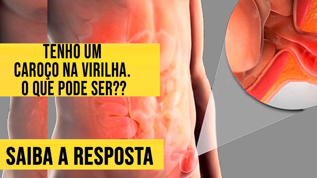 TENHO UM CAROÇO NA VERILHA O QUE PODE SER? - YouTube