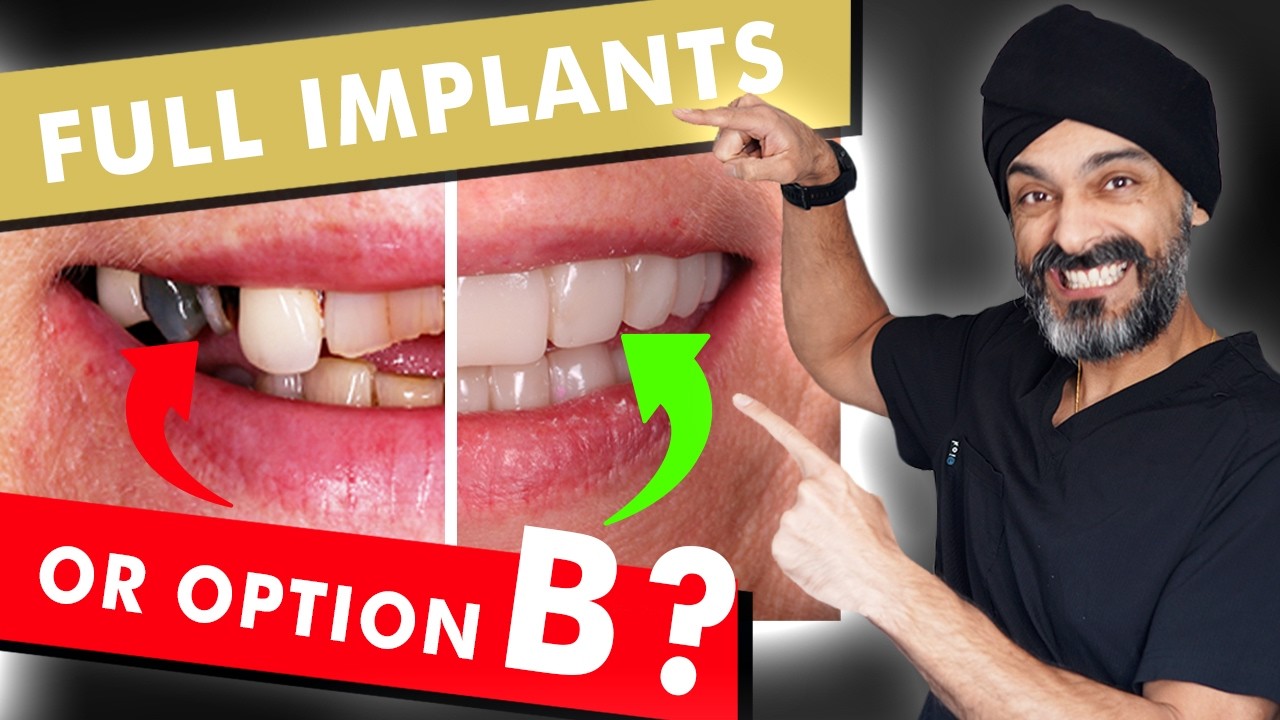 All on 4 or Another Way to Have a Full Set of Dental Implants? - YouTube