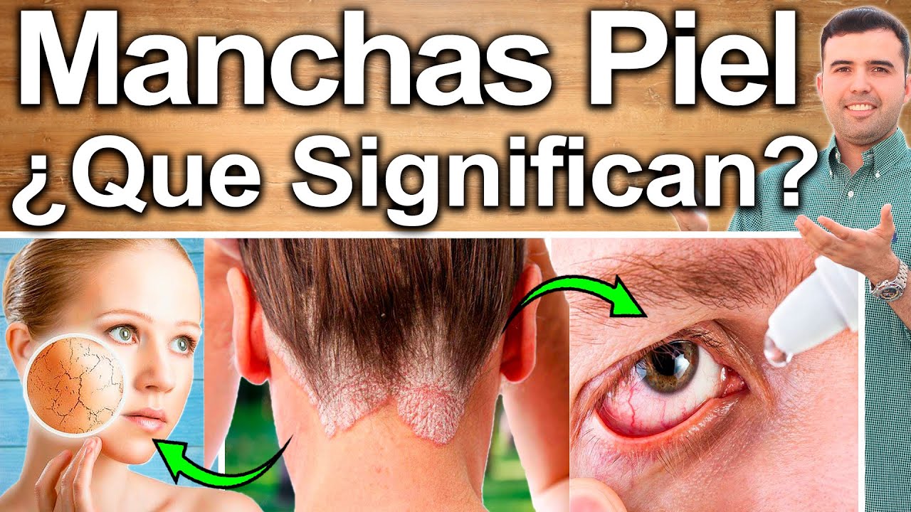 ESTO INDICA LA SEQUEDAD DE PIEL! -Causas Y Soluciones Para Eliminar La ...