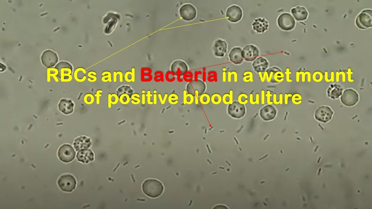 RBCs and Klebsiella oxytoca in Wet mount of positive blood culture |Tryptone soy broth - YouTube