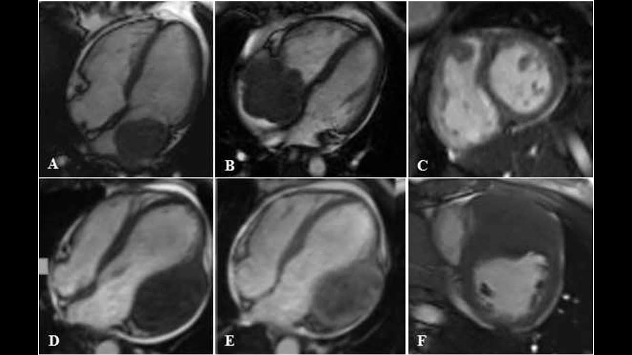 CMRI (Cardiac MRI) Heart MRI - YouTube
