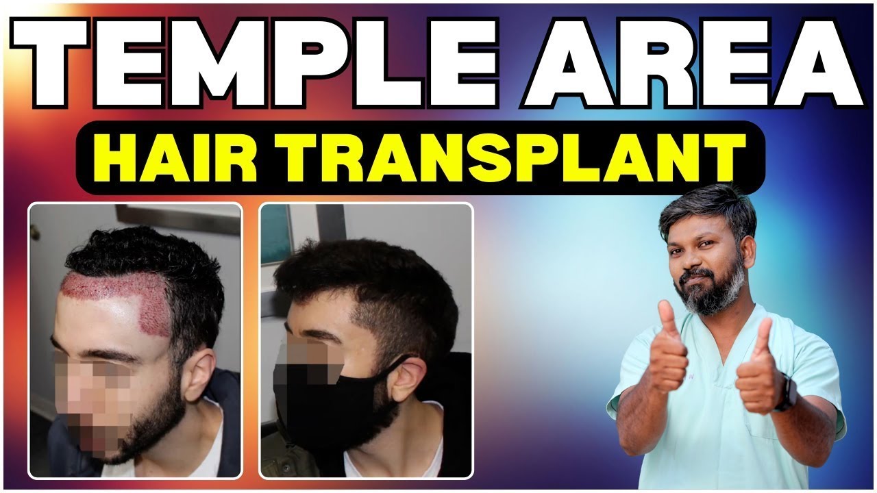 #AskDrJohnWatts | TEMPLE AREA HAIR TRANSPLANT | Hair Specialist ...
