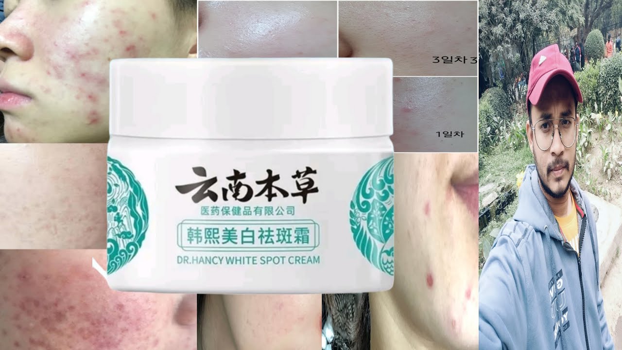kirozi Japanese melasma cream | Dr hancy white spot cream | honest ...