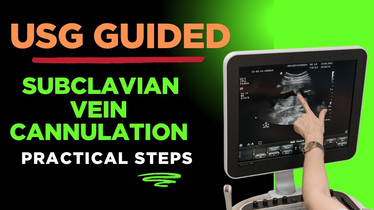 USG Guided Central Venous Cannulation | USG Guided Subclavian Line ...