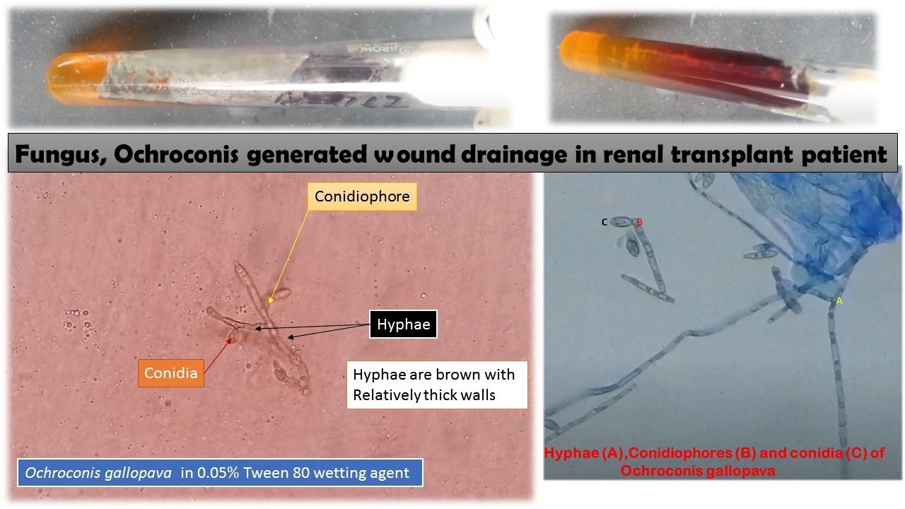Fungus, Ochroconis generated wound drainage in renal transplant patient ...