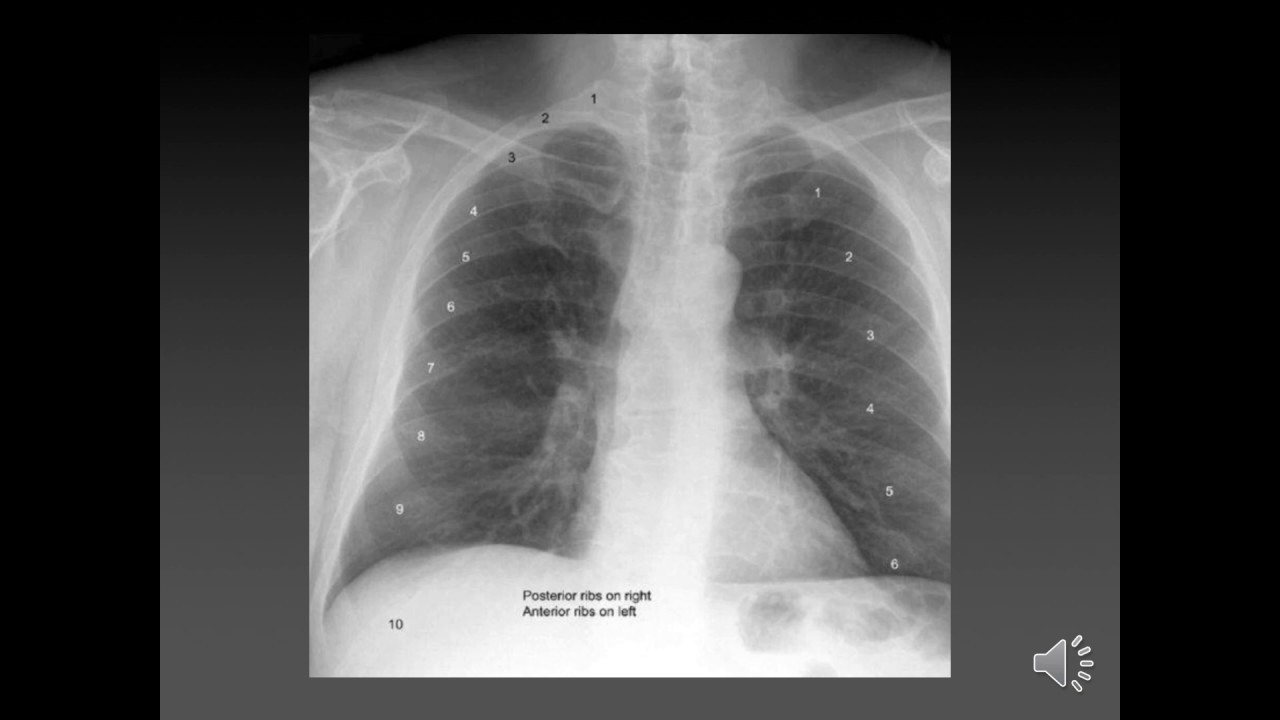 Assessing CXR inspiration (5/8) - YouTube
