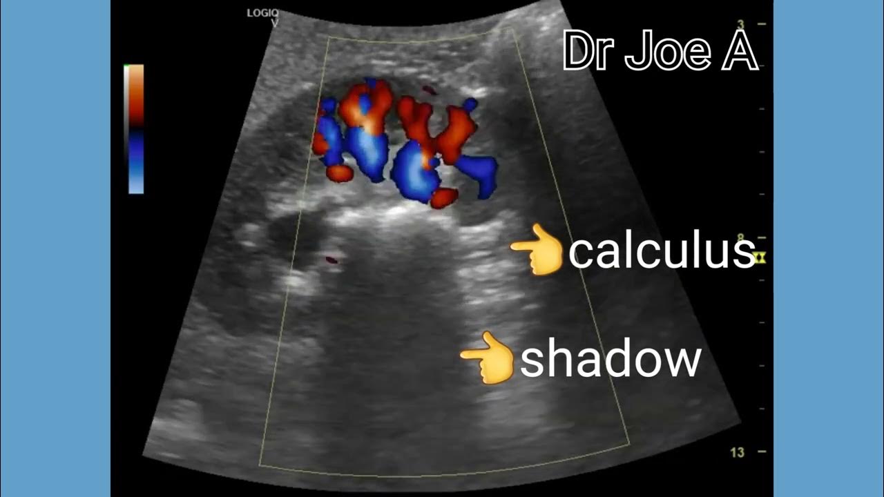 staghorn-calculus-right-kidney-ultrasound-and-color-doppler-video