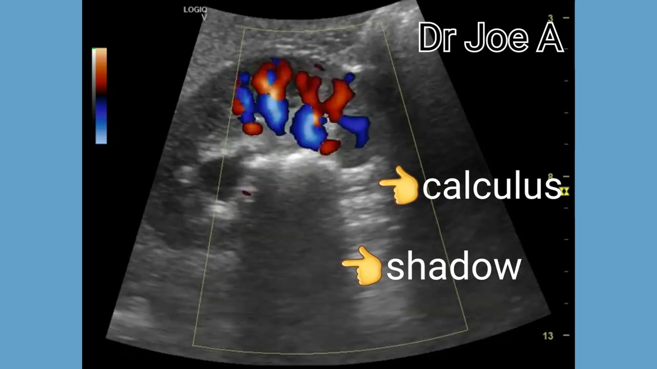 Staghorn Calculus Right Kidney Ultrasound And Color Doppler Video Staghorn Calculus Right Kidney Ultrasound And Color Doppler Video