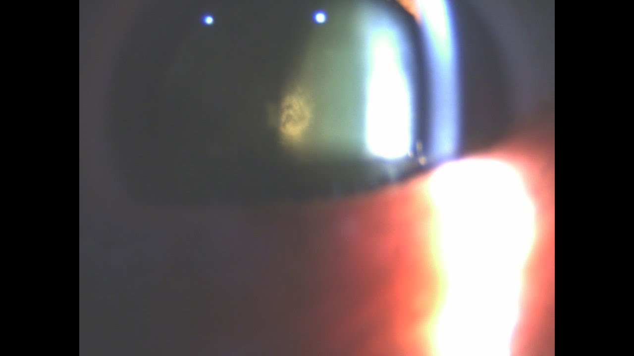 phaco chop cataract surgery, PSC type, eyhance IOL - YouTube