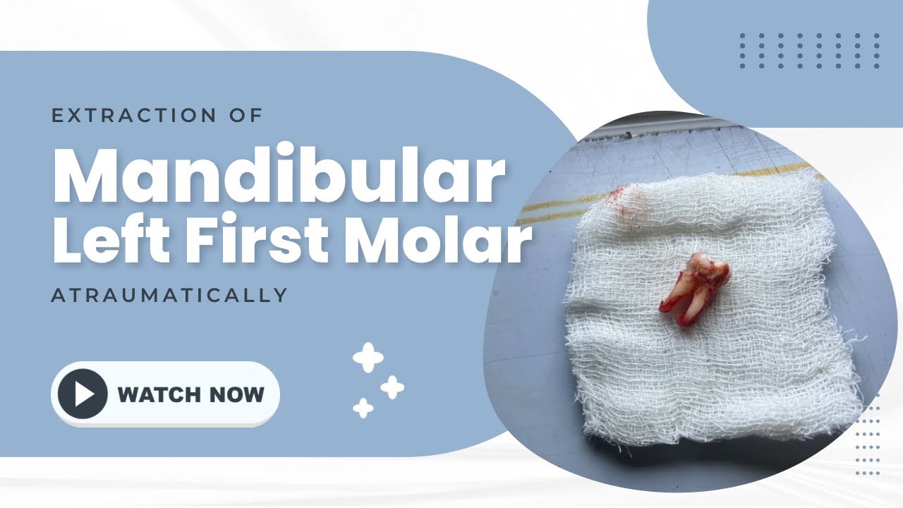 Mandibular Lower left first molar removal | Extraction of Mandibular ...