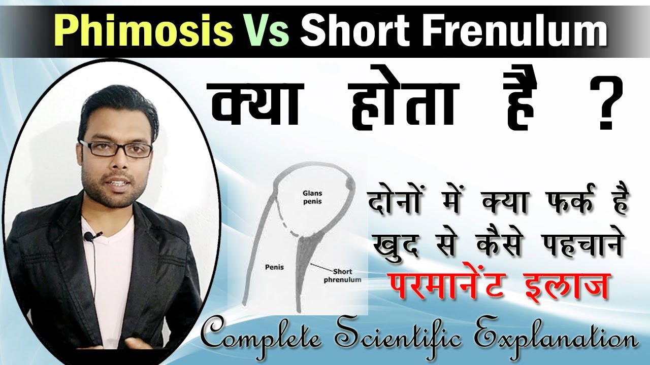 फिमोसिस और टाइट फ्रेनुलम का इलाज | Phimosis Vs short frenulum ...