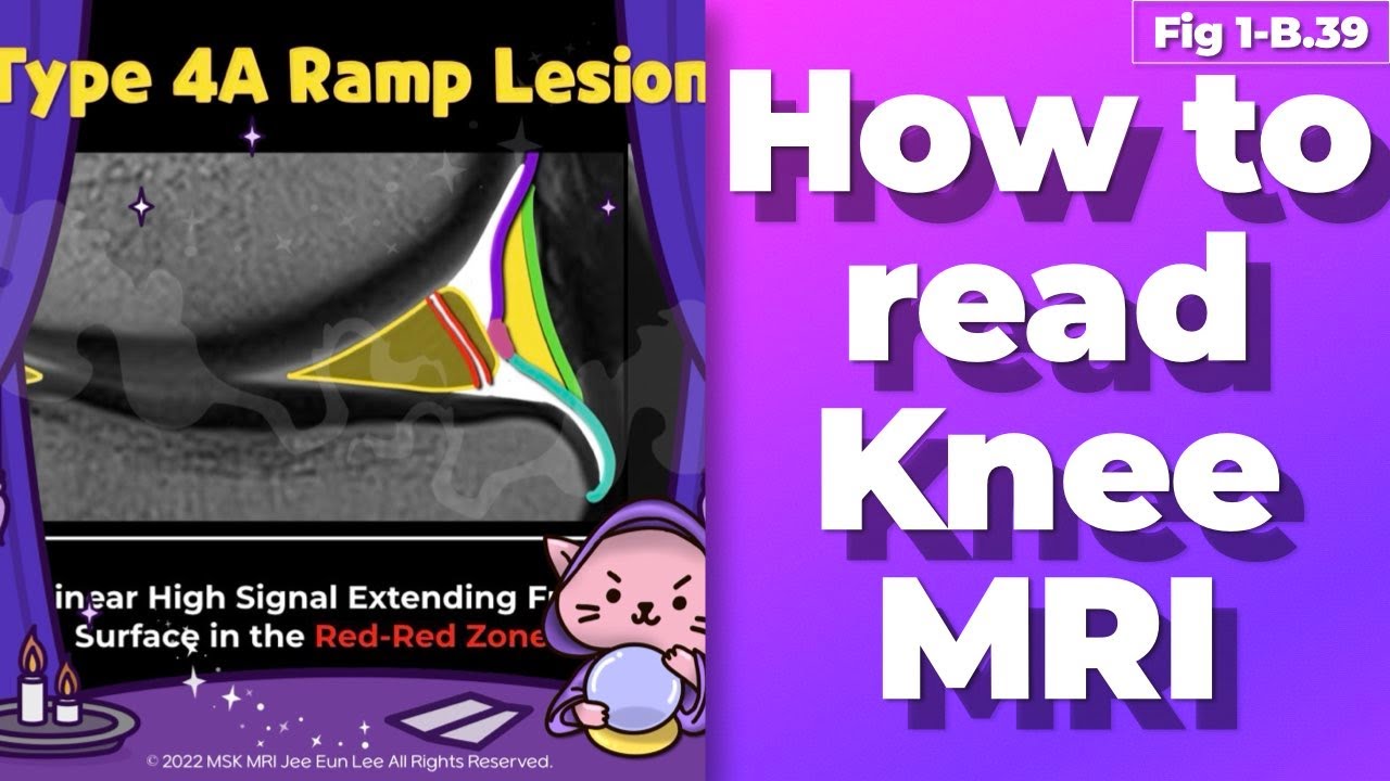 (Fig 1-B.39) Type 4A Ramp lesion - YouTube