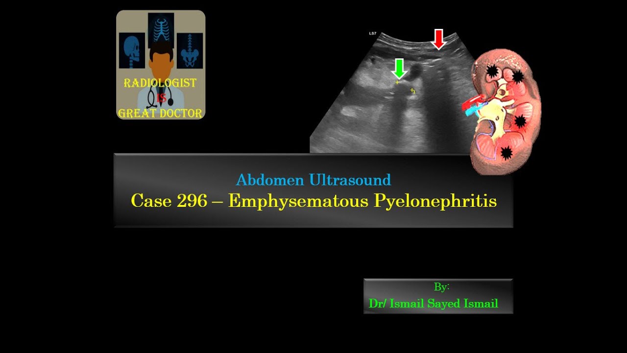 Ultrasound Case 296 - Emphysematous Pyelonephritis - YouTube