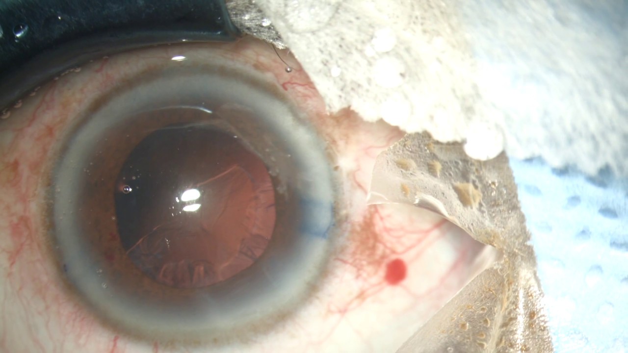 CCC Cataract Surgery - YouTube