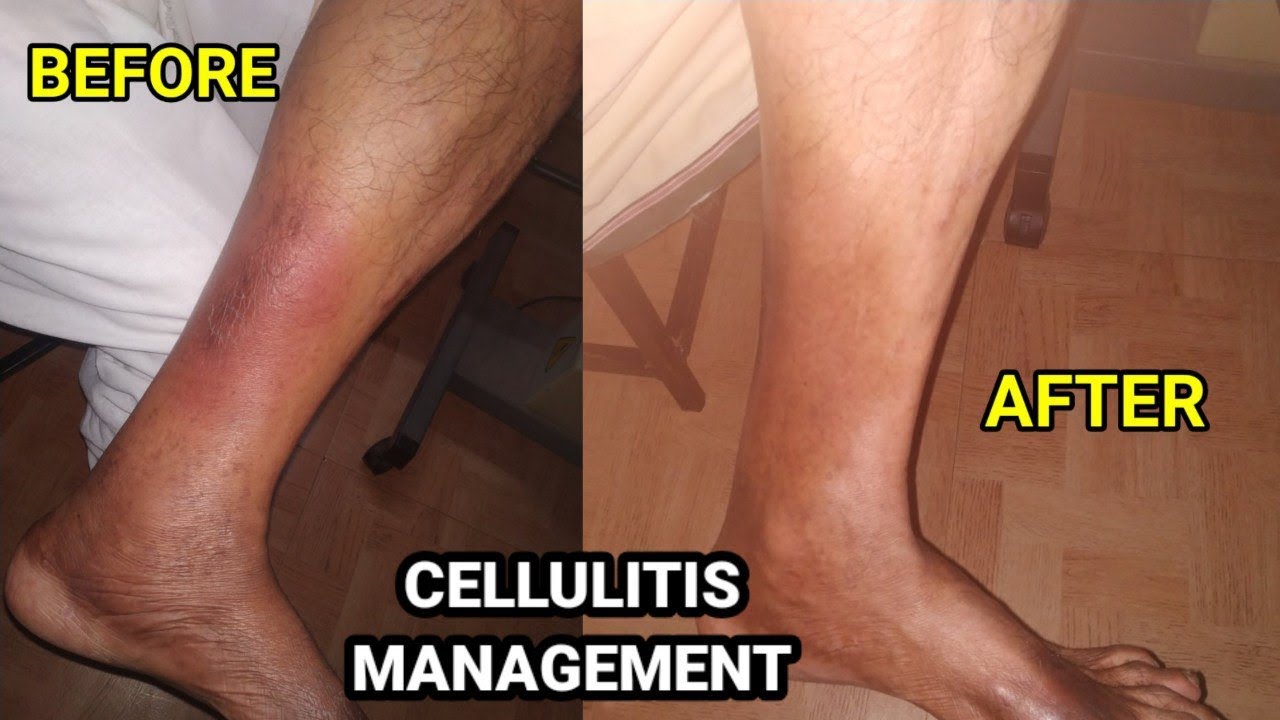 Ayurvedic management of cellulitis | Single case study - YouTube