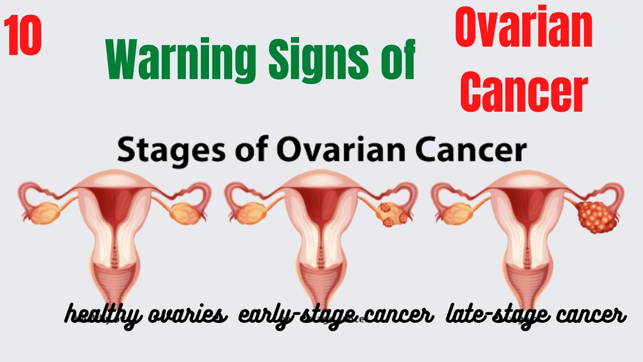 Early Warning Signs Of Ovarian Cancer 10 Obvious Signs Of Ovarian Cancer Youtube