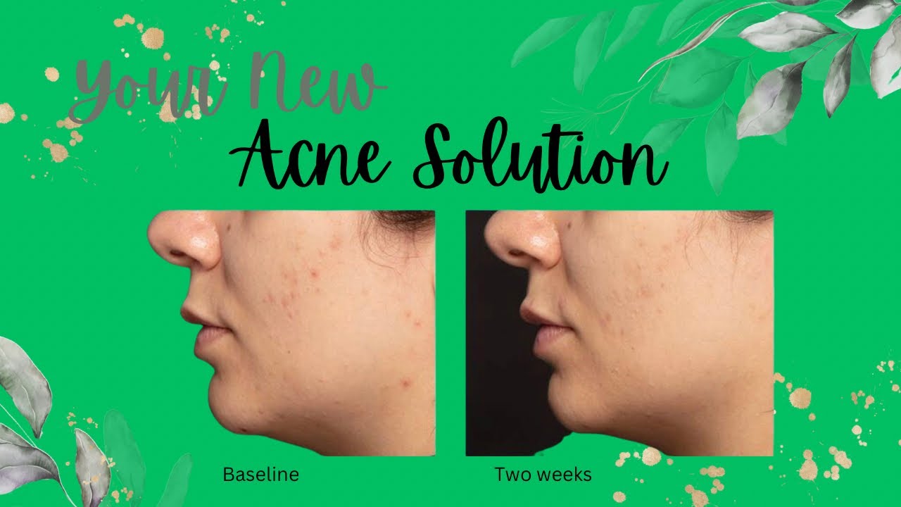 Clear Skin Secret, Ultimate Blemish Serum: Silver & Salicylic Acid for ...