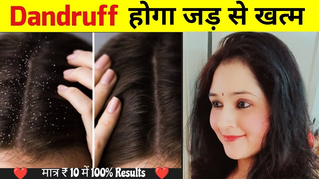Cheap Hacks to get rid of dandruff | How to get rid of dandruff ...