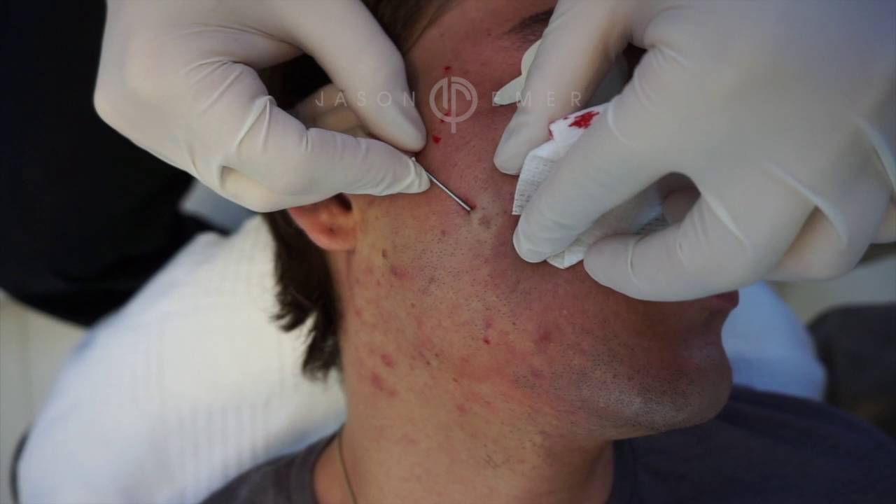 Subcision for Acne Scar Treatment | Subcision Acne Scars Results ...