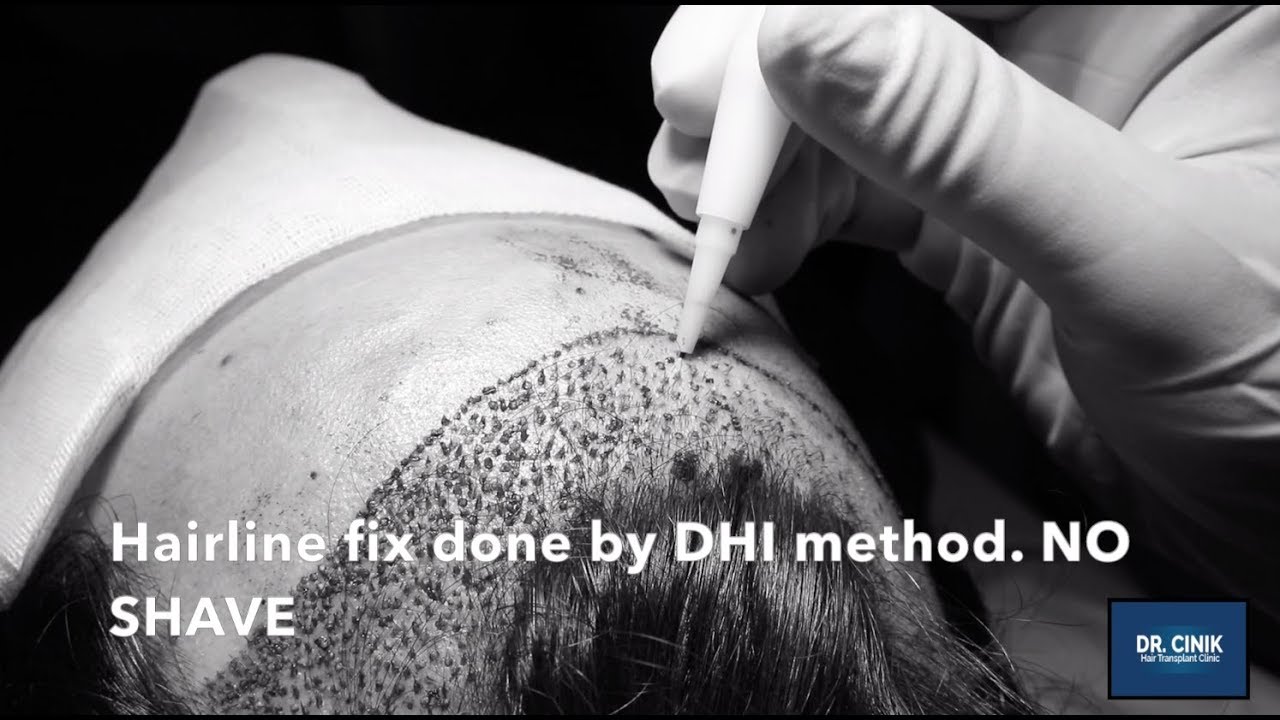 Dr. Cinik Hairtransplant Clinic / DIRECT HAIR IMPLANTATION (DHI) | Hair ...