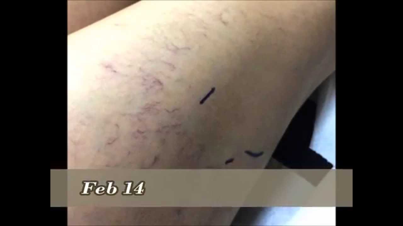 Varicose Veins Treatment by VenoCare Dubai - YouTube