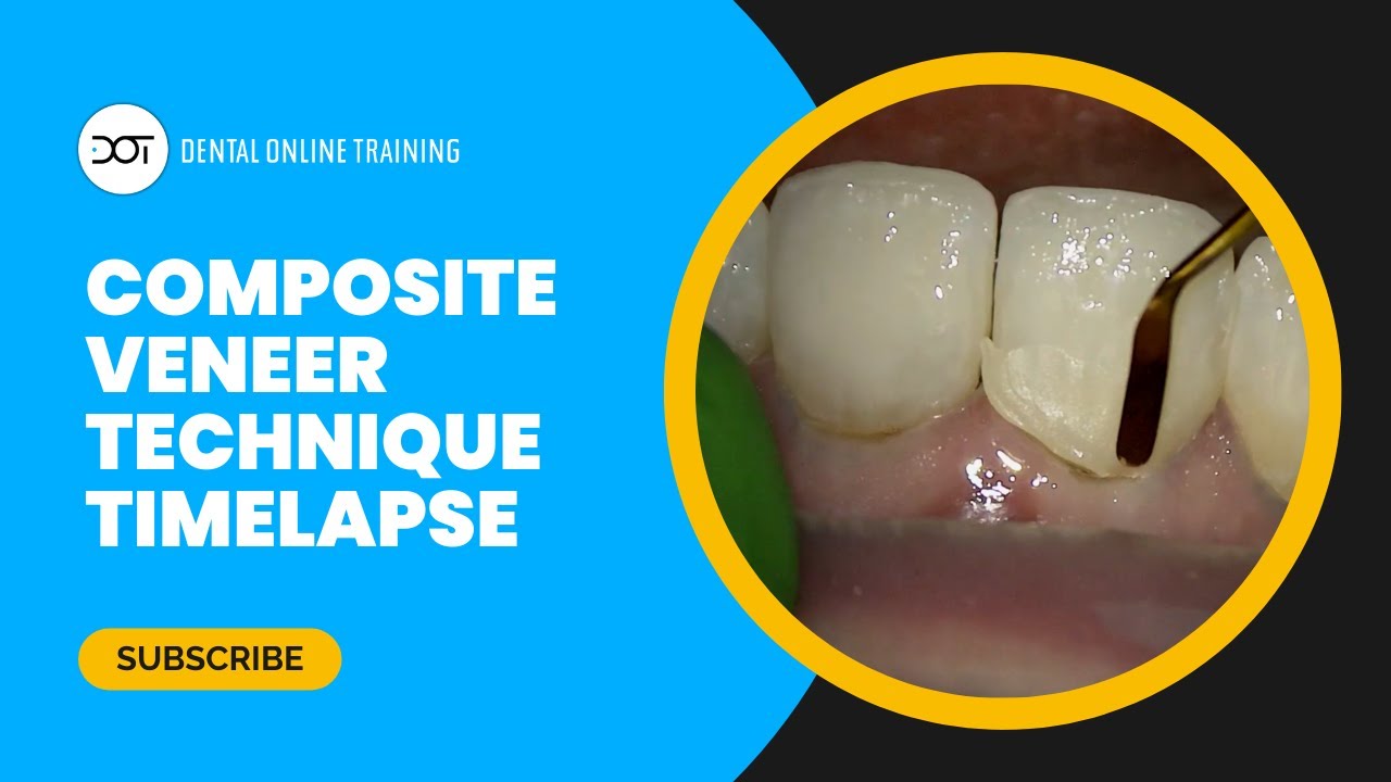 Composite Veneer Technique Timelapse | Dental Online Training - YouTube
