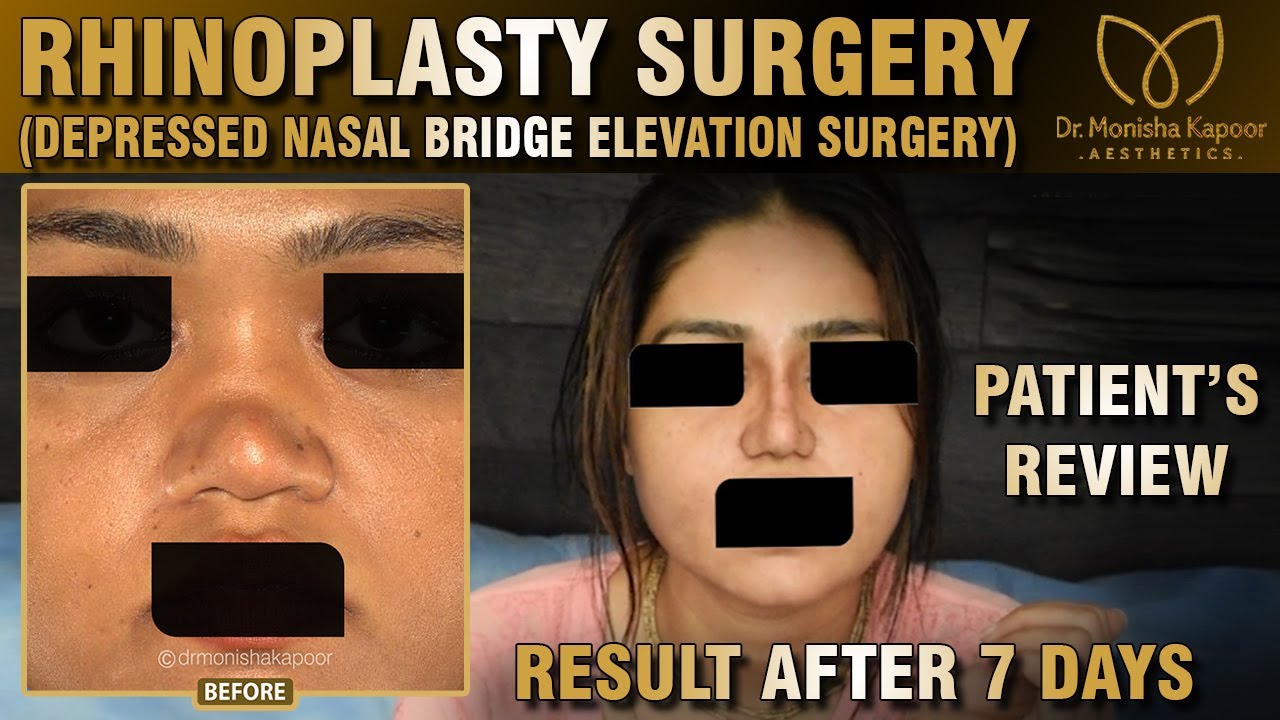 Patient's Review | Rhinoplasty (Depressed Nasal Bridge) | Result after ...