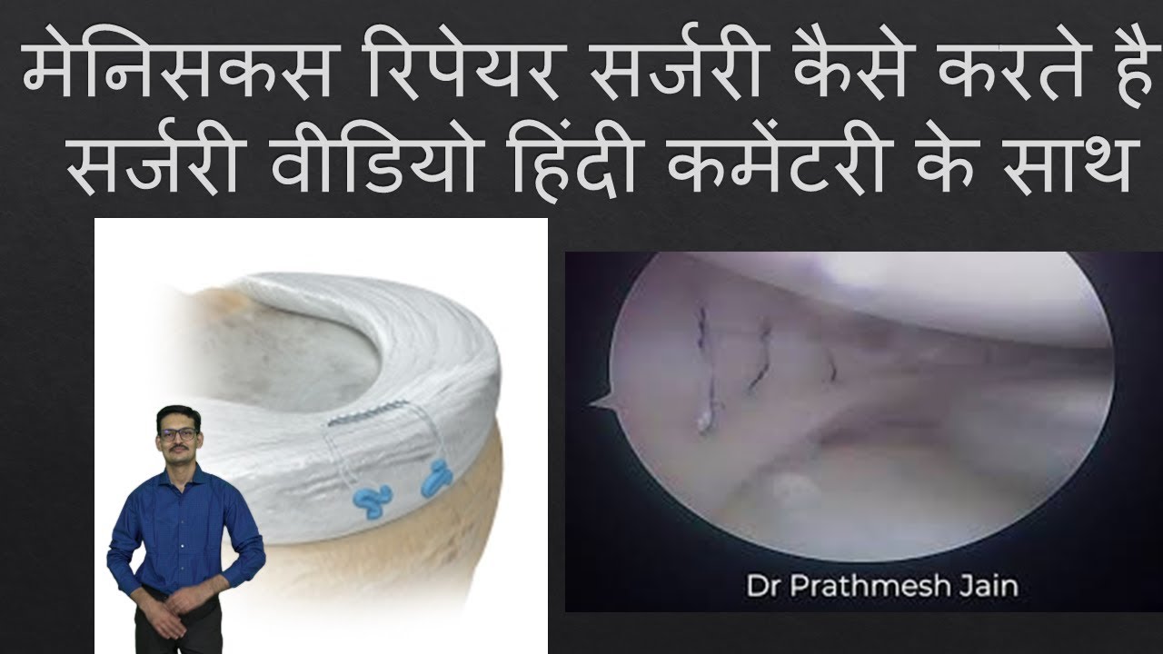 Inside Out Meniscal Repair Hindi (Gold Standard Meniscus Repair)मेनिसकस ...