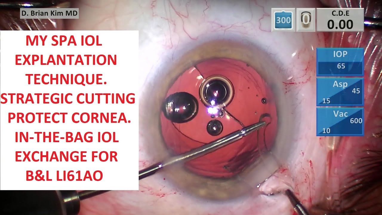 My SPA IOL Explant Technique. Strategic Holding & Cutting. Shield the ...