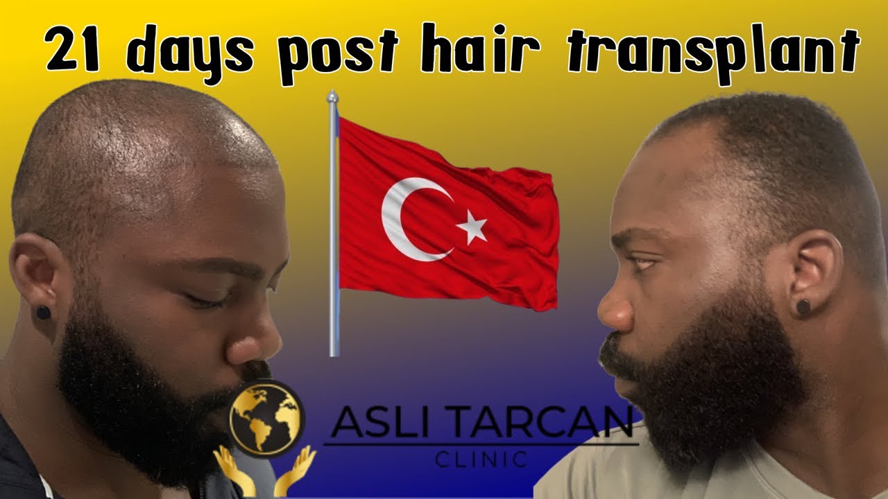Asli Tarcan black hair 21 days post DHI hair transplant results. Episode: 6 - YouTube