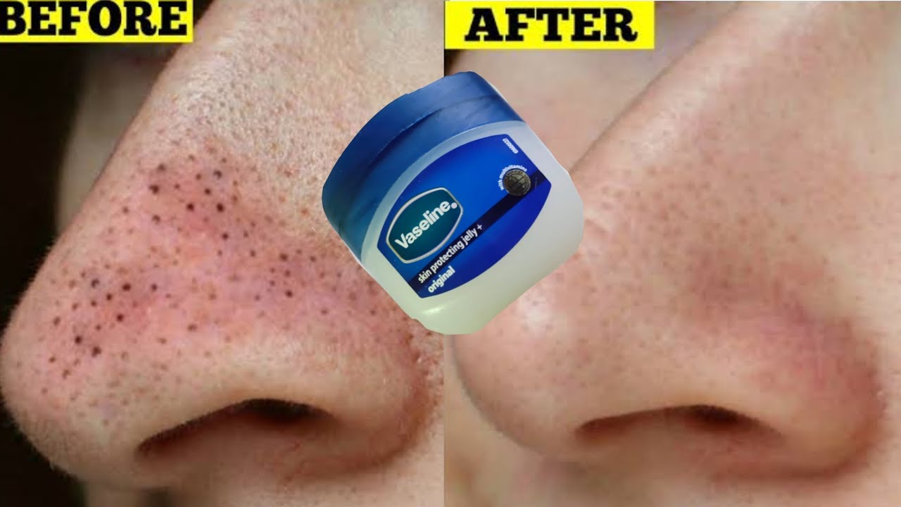 How To Remove Blackheads At Home How To Get Rid Of Blackheads how-to-remove-blackheads-at-home-how-to-get-rid-of-blackheads