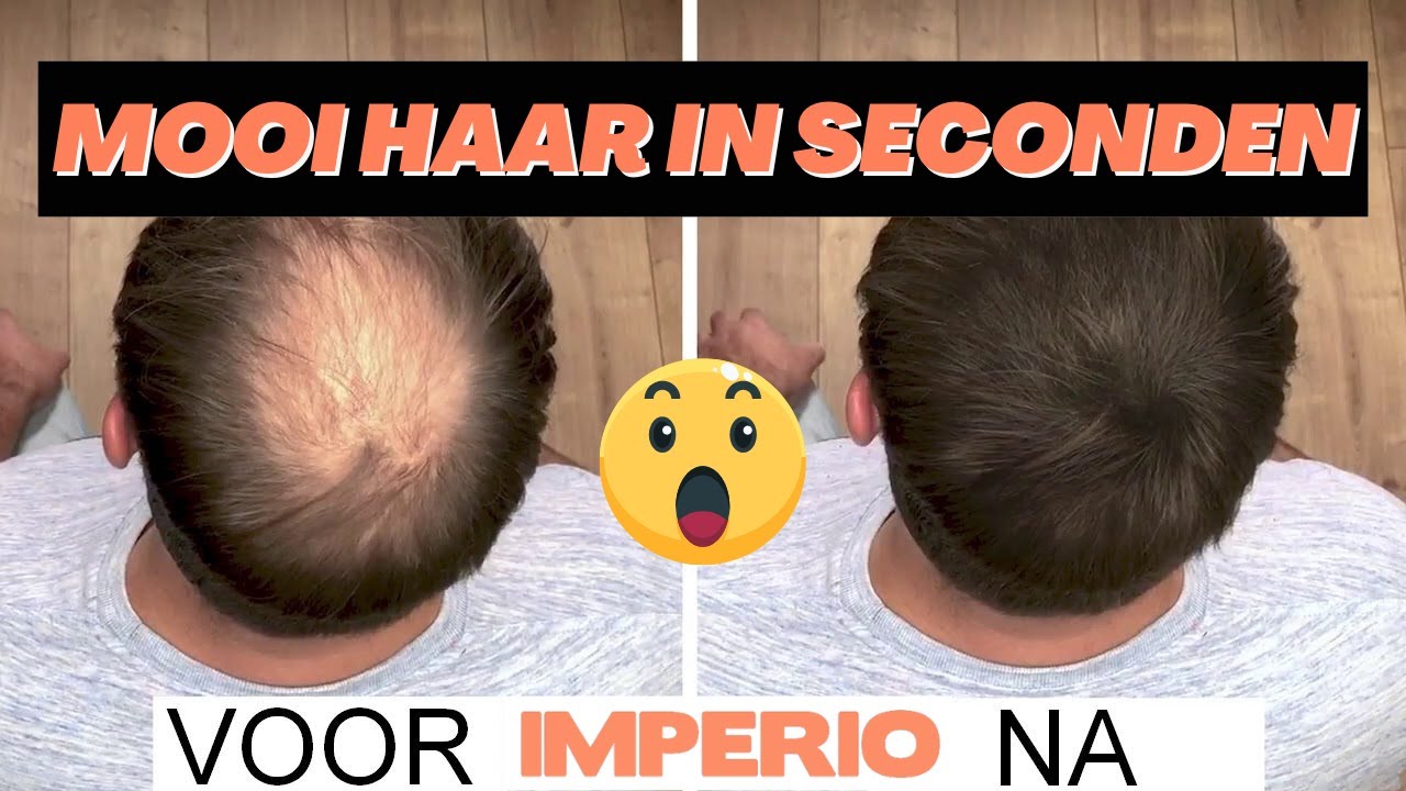 Kaal Worden Man Oplossing · Weer Mooi Vol Haar In 20 Seconden. - YouTube