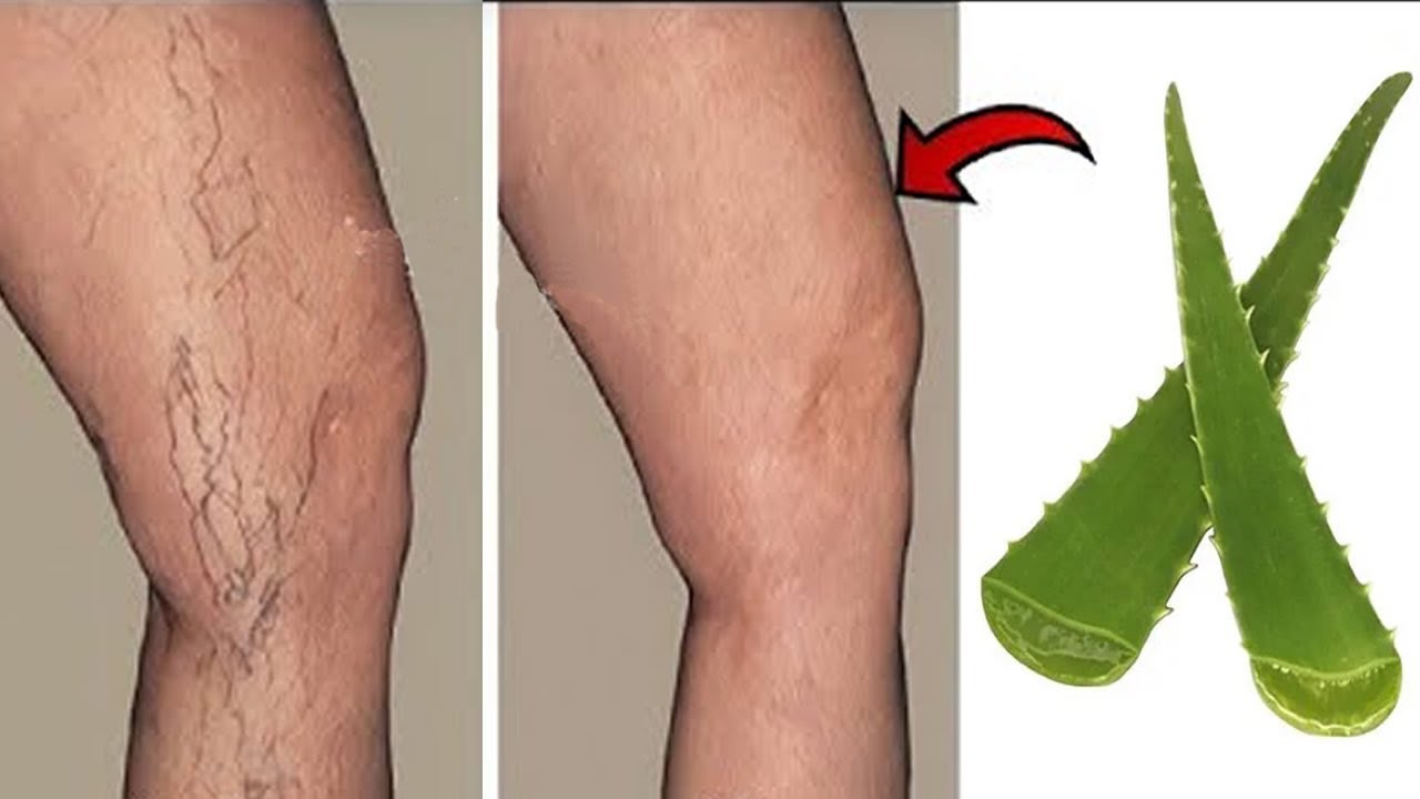 Diga adeus às VARIZES e dores nas Articulações com apenas 2 ...