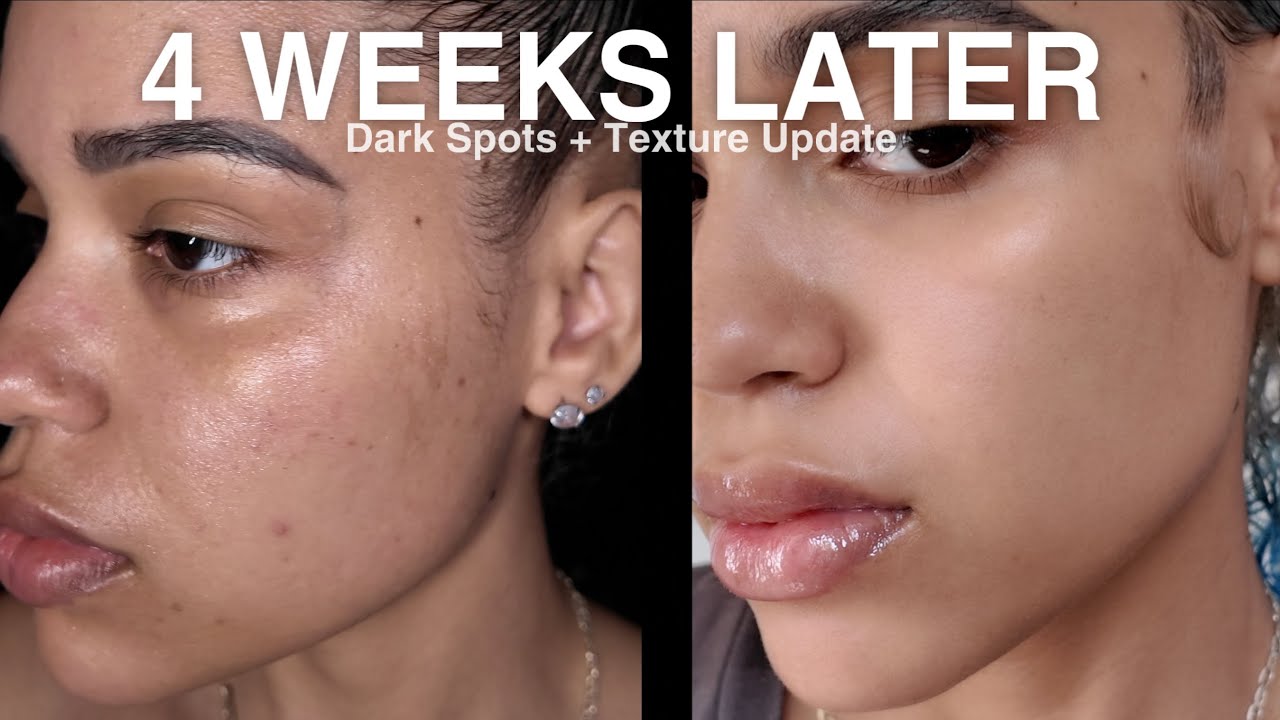 I Tried the VIRAL Acne Scar Kit for 4 Weeks — Here's What Happened ...