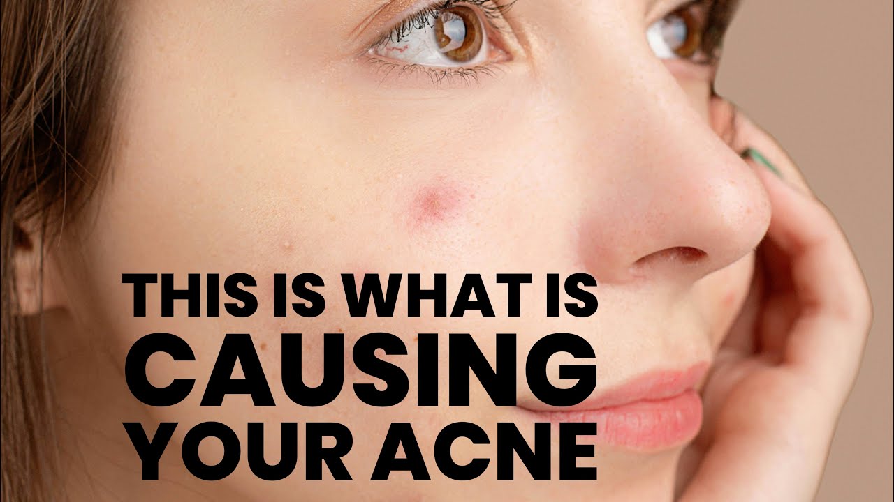 Is your skin pH causing your ACNE? The complete acne solution Part 5 ...